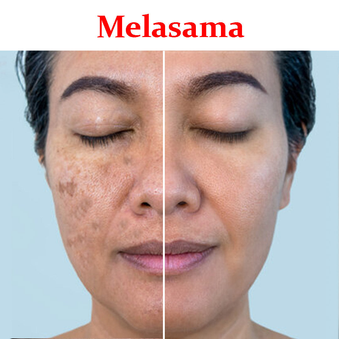 Melasma Maintenance Treatment – Sharma Pharmacy