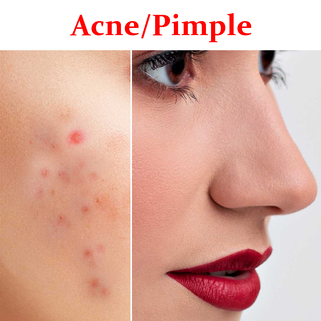 Pimples/Acne- Product Box – Sharma Pharmacy